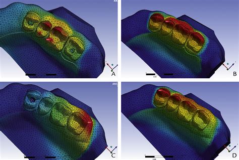 Three Dimensional Finite Element Analysis Of Implant Assisted Removable Partial Dentures