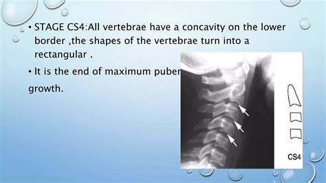 Skeletal Maturation Evaluation Using Cervical Vertebrae Pptx