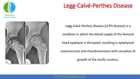 Legg Calve Perthes Disease