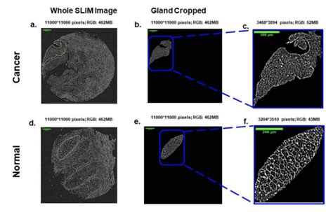 Label Free Colorectal Cancer Screening Using Deep Learning And Spatial Light Interference