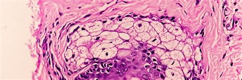 Jak1 Inhibitor Meets Primary Endpoint In Prurigo Nodularis Trial Physicians Weekly