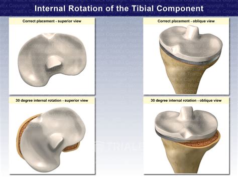 Internal Rotation Of The Tibial Component TrialQuest Inc