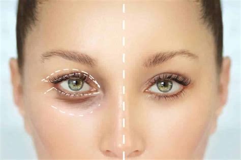 Aftercare For Blepharoplasty Philadephia Dr Kirk Lozada