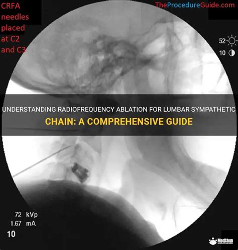 Understanding Radiofrequency Ablation For Lumbar Sympathetic Chain A