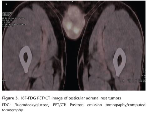 Congenital Adrenal Hyperplasia And Testicular Adrenal Rest Tumors
