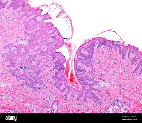 Papilloma Light Micrograph Papilloma Of Scalp Where The Border Between Epidermis And Dermis