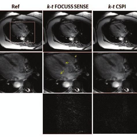 Comparison Among K T Focuss With Sense Proposed K T Cspi And Download Scientific Diagram