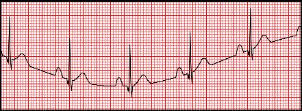 Artifacts On EKG Flashcards Quizlet