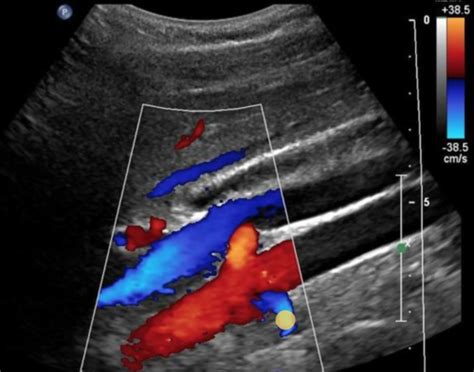 Ardms Vascular Ctl Exam Anatomy Pt 1 Flashcards Quizlet