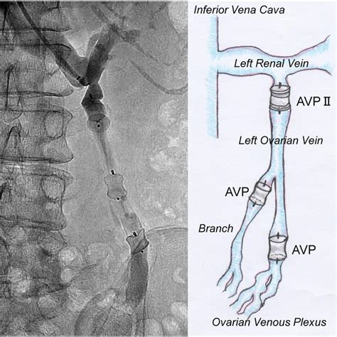 A 3 Dimensional Ct Image Of Incompetent Pelvic Veins B Arterial