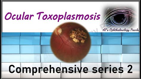 Ocular Toxoplasmosis Comprehensive Series 2 Youtube