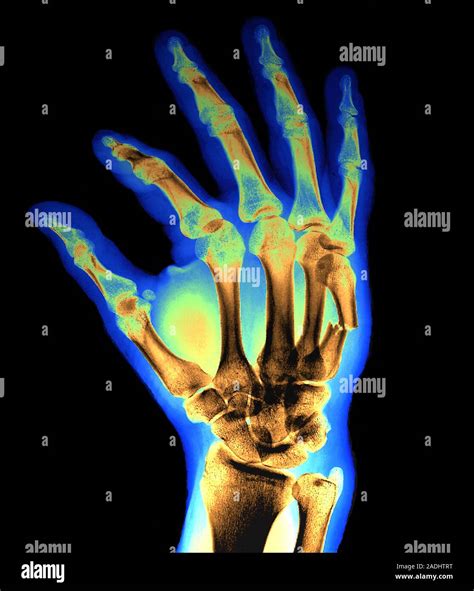 Broken Hand Bone Coloured X Ray Of The Right Hand Of A Patient Showing A Fracture Lower Right