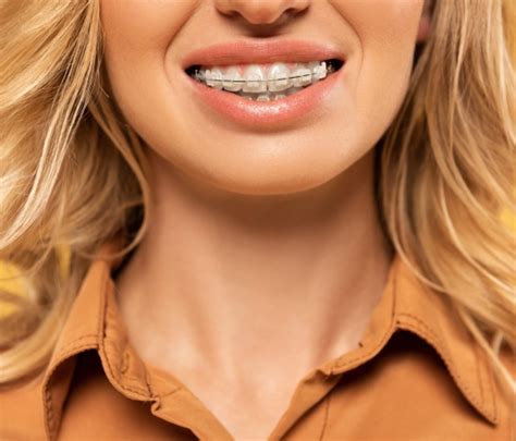 How Long Do Braces Take What To Expect When Getting Them