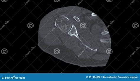Ct Scan Of Shoulder Joint In Case Fracture Shoulder Joint Royalty Free