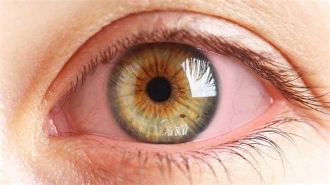 Spotting Pink Eye Recognising Conjunctivitis Symptoms Early