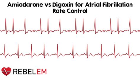 Atrial Fibrillation With Rvr