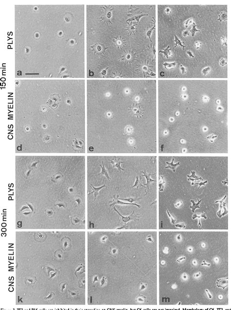 Figure 3 From Glioblastoma Infiltration Into Central Nervous System