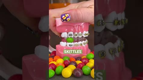 Foods You Cant Eat With Braces Braces Teeth Candy Snacks Shorts Youtube