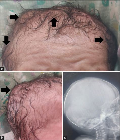 Seroma A Rare Cause Of Neonatal Scalp Swelling Indian Pediatrics Case Reports