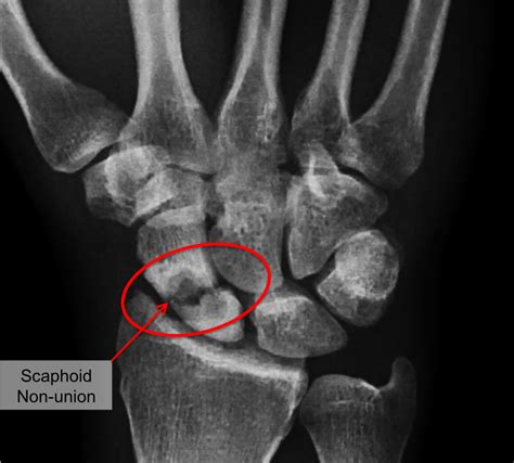Scaphoid Fracture Raleigh Hand Surgery — Joseph J Schreiber Md