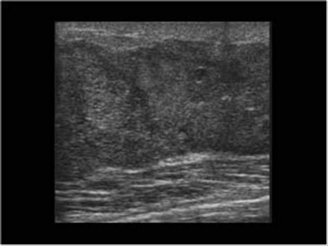 Breast And Axilla 5 2 Malignant Breast Lesions Case 5 2 12 Lymph