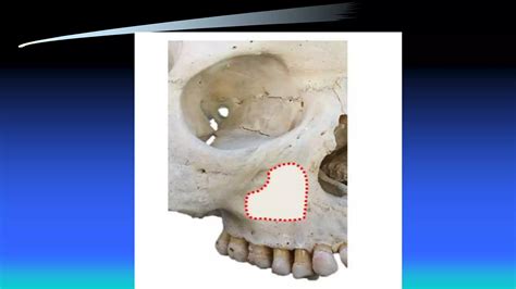 Maxillectomy And Craniofacial Resection Pptx