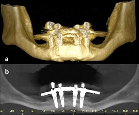 Mandibular Cone Bean View A And Axial Slice Computed Tomography B