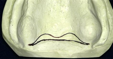 Fovea Palatinae Pain Location Purpose Swollen