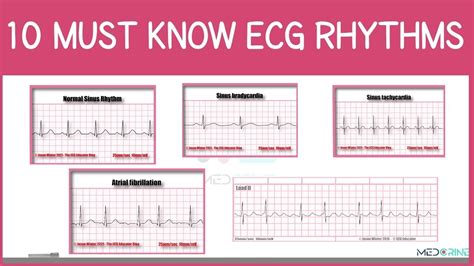 Top 10 Must Know Electrocardiogram Ecg Rhythms Simplified Ecg Interpretation Made Easy