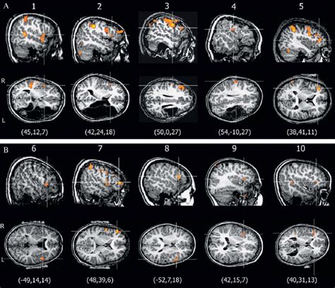 Sagittal And Axial Views Of Fmri Activation In The Frontal Cortex
