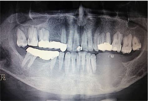 Huge Corticated Radiolucency With Well Defined Borders Measuring 3 × 4 Download Scientific