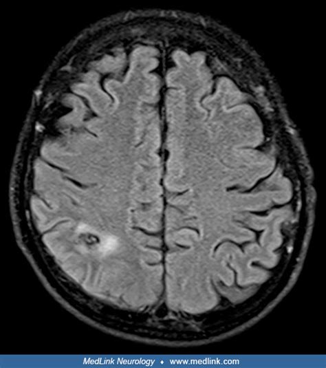 Infective Endocarditis Medlink Neurology