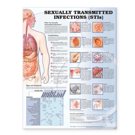 Sexually Transmitted Infections Anatomical Chart Soft Laminate