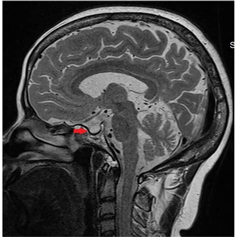 Ecg After 1 Month Showed That Corrected Qt Interval Had Returned To