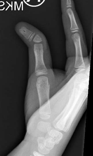 Two Different Thumb Birth Differences Congenital Hand And Arm