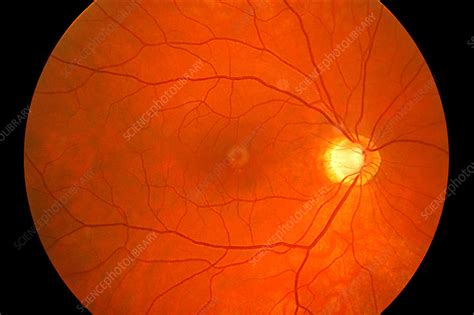 Glaucoma Fundus Image Stock Image C Science Photo Library