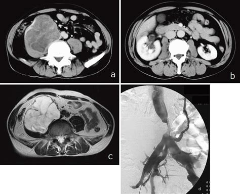 A B Ct Shows A Soft Tissue Density Mass 12 Cm On The Caudal Side Of