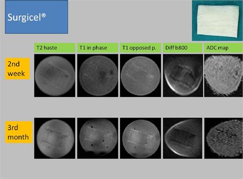 Figure 1 From Magnetic Resonance Imaging Features Of Hemostatic Agents And Tissue Sealants After