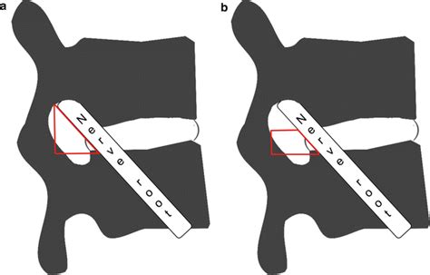 Diagram Showing The Kambin Triangle A And Actual Working Zone B