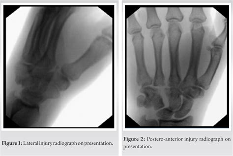 Isolated Hamate Dislocation A Case Report And Technique Guide