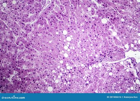 Hepatic Steatosis Light Micrograph Stock Image 311783359