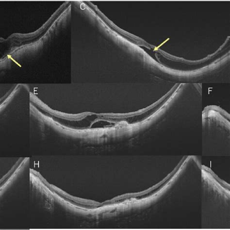 A 66 Year Old Woman With An Axial Length Of 28 63 Mm Myopic Choroidal Download Scientific
