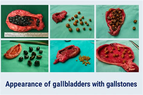 Gallstone Disease Treatment Singapore Laparoscopic Gallbladder Surgery