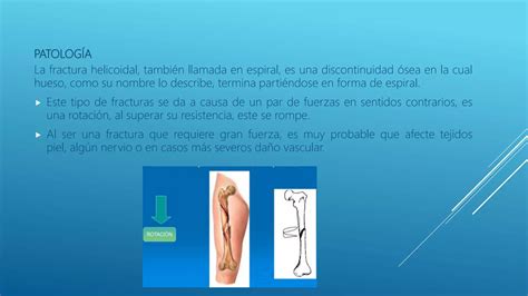 Fractura Helicoidal Caso Clinico Ppt
