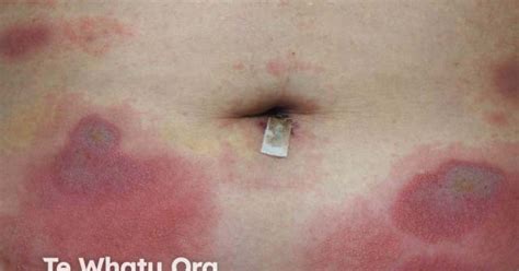 Fixed Drug Eruption Image