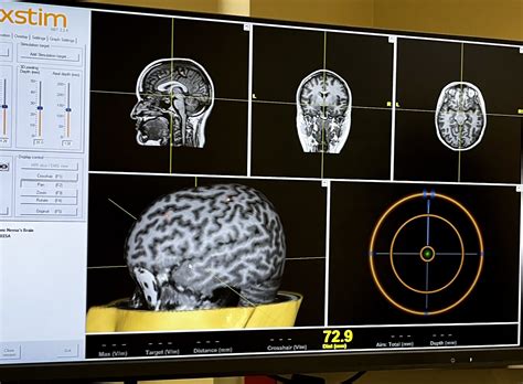 Tms With Neuronavigation Brain Health Consultants And Tms Center