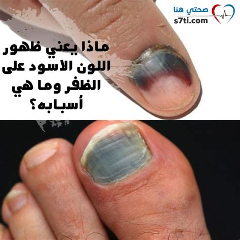 الظفر الأسود ماذا يعني وما هي أسبابه؟ صحتي هنا
