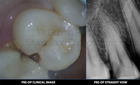 Radiculous Small Molars Molarized Premolars Three Canalled Maxillary