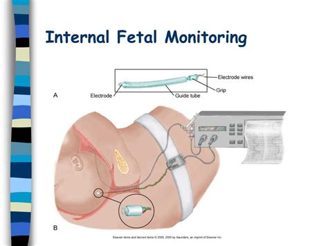Ppt Fetal Monitoring Powerpoint Presentation Free Download Id 3127064