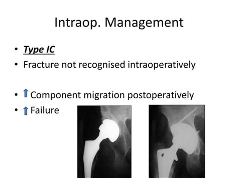 Intraoperative Acetabular Fracture And Pelvic Discontinuity In Thr Ppt